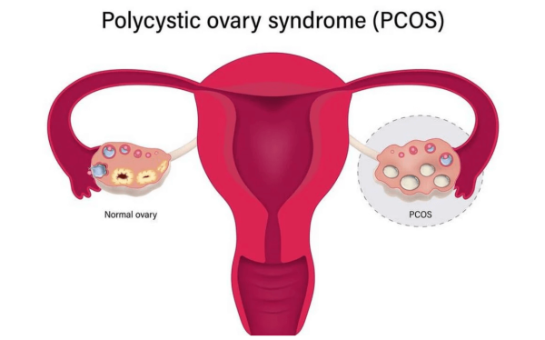 Lean PCOS; PCOS zonder overgewicht